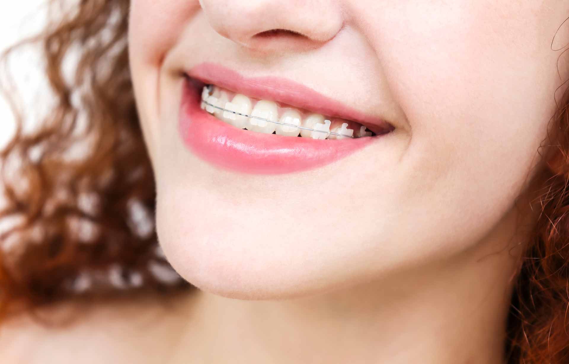 Braces: Types, Cost, and Treatment| Gentle Dental Orthodontics