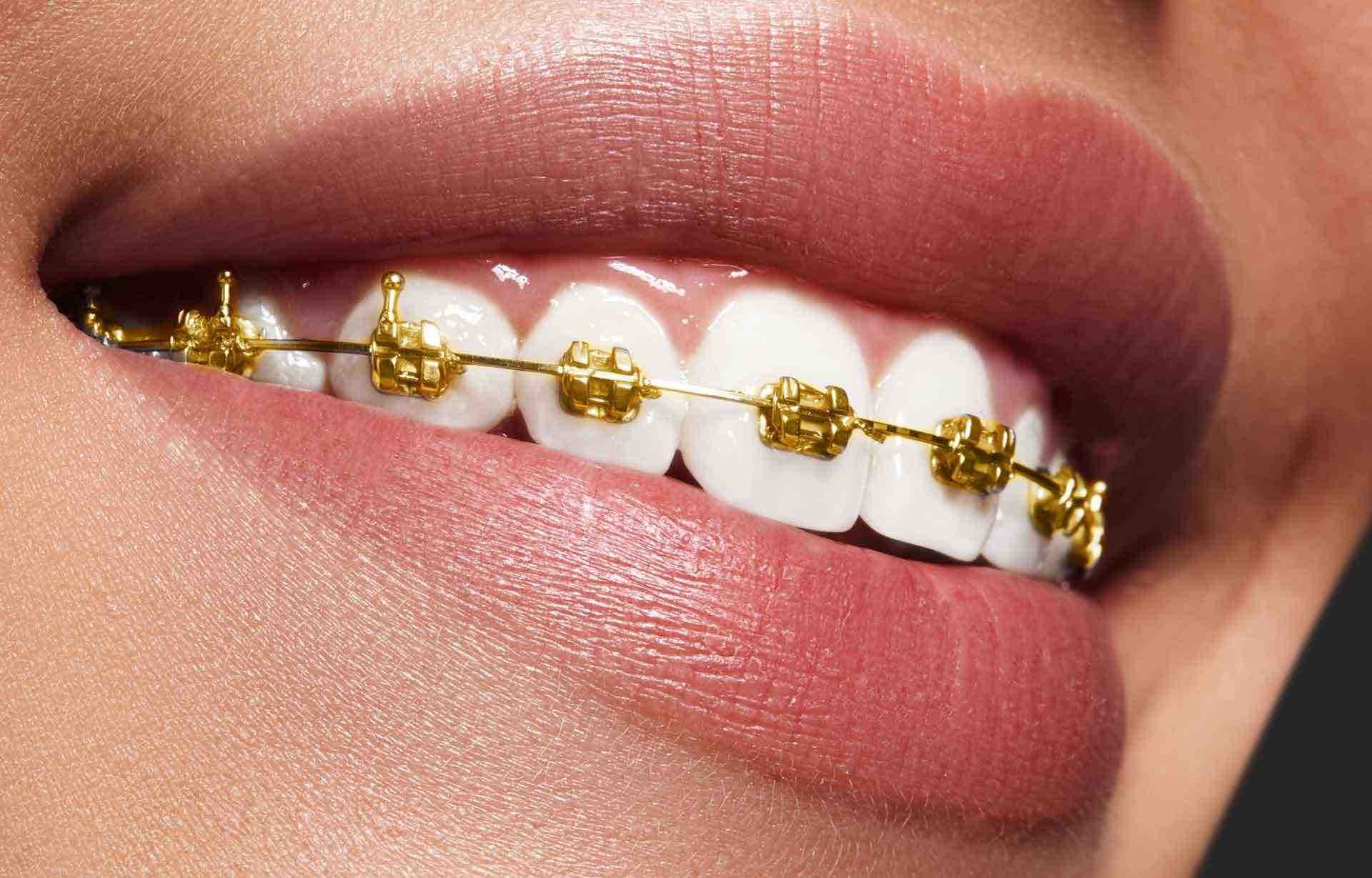 Braces: Types, Cost, and Treatment| Gentle Dental Orthodontics